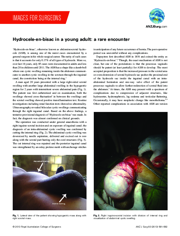 (PDF) Hydrocele-en-bisac in a young adult: a rare encounter