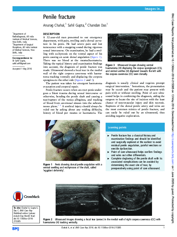 (PDF) Penile fracture
