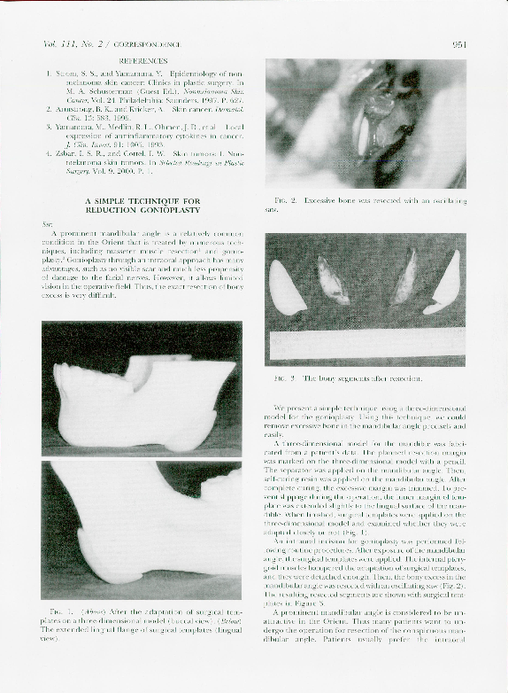 (PDF) A Simple Technique for Reduction Gonioplasty