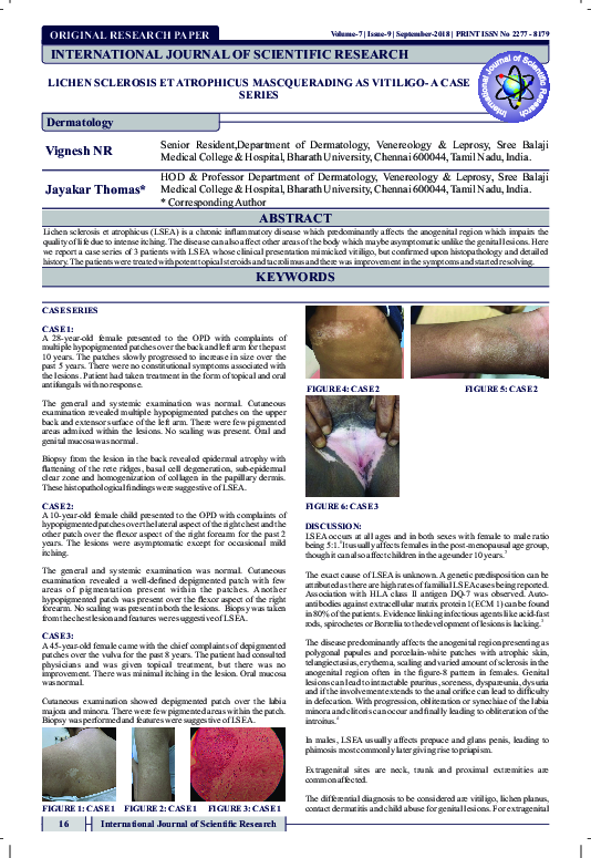(PDF) Lichen Sclerosis et Atrophicus Mascquerading as Vitiligo– a Case ...