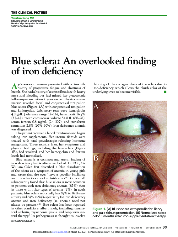 (PDF) Blue sclera: An overlooked finding of iron deficiency