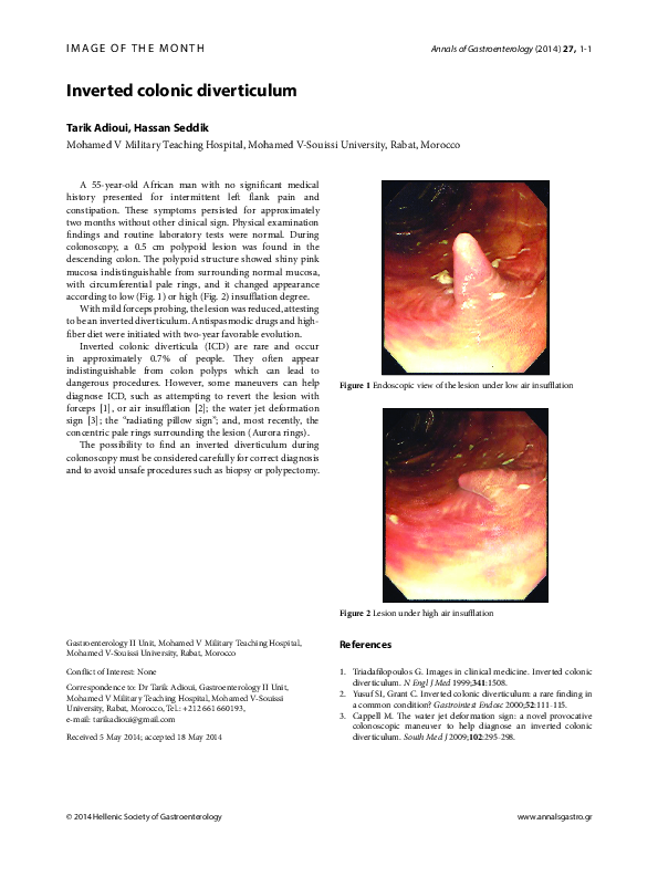 (PDF) Inverted colonic diverticulum
