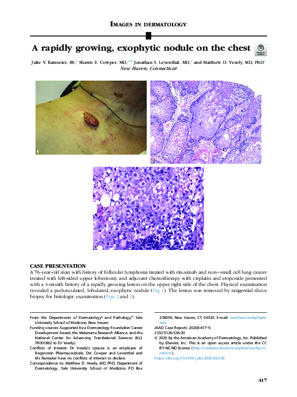 (PDF) A rapidly growing, exophytic nodule on the chest
