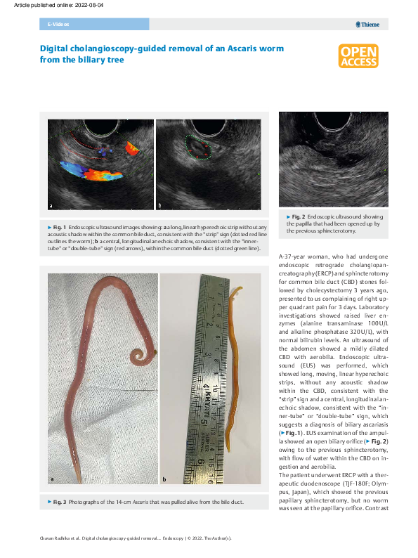 (PDF) Digital cholangioscopy-guided removal of an Ascaris worm from the ...