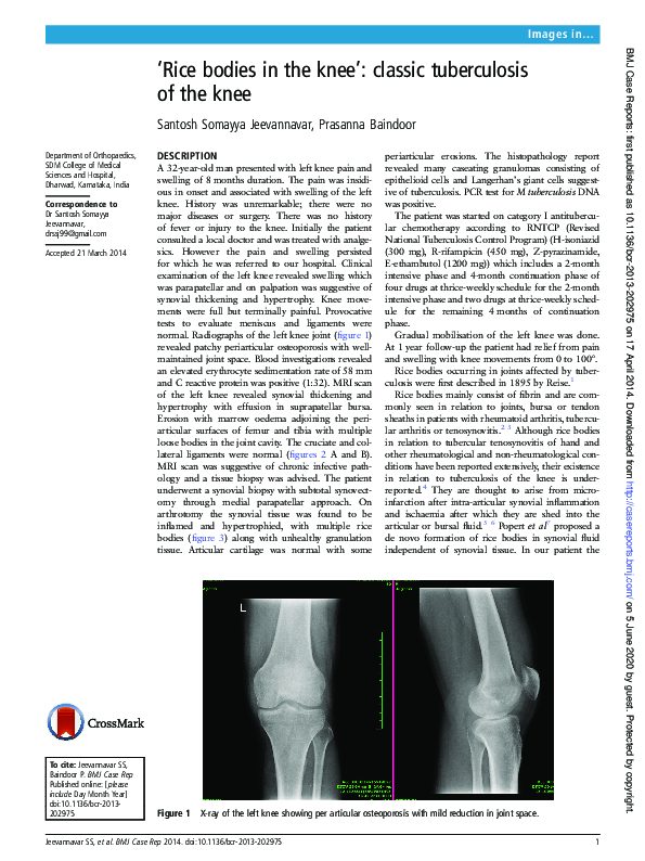 (PDF) Rice bodies in the knee': classic tuberculosis of the knee