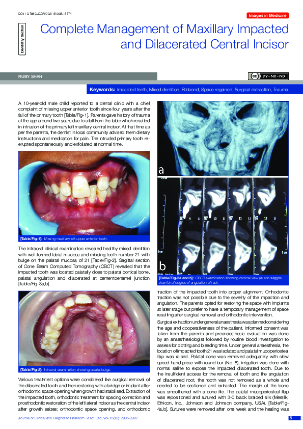 (PDF) Complete Management of Maxillary Impacted and Dilacerated Central ...
