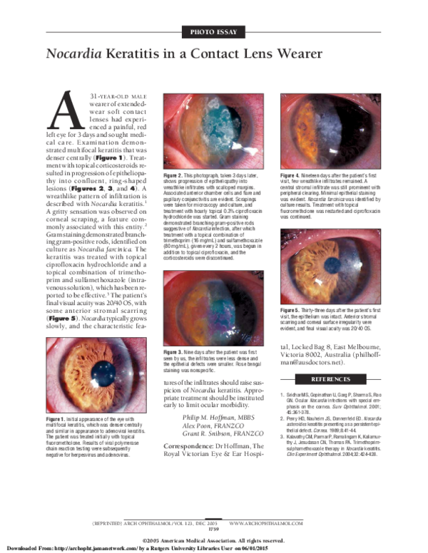 (PDF) Nocardia Keratitis in a Contact Lens Wearer | Grant Snibson ...