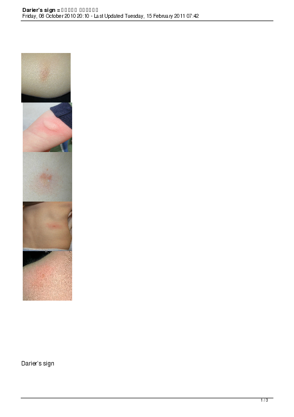 (PDF) Darier's sign