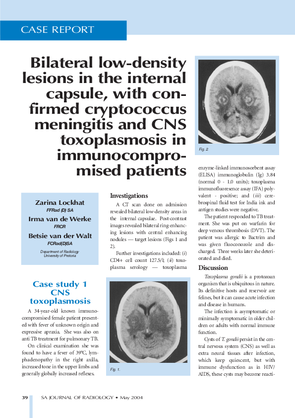 (PDF) Bilateral low-density lesions in the internal capsule, with ...
