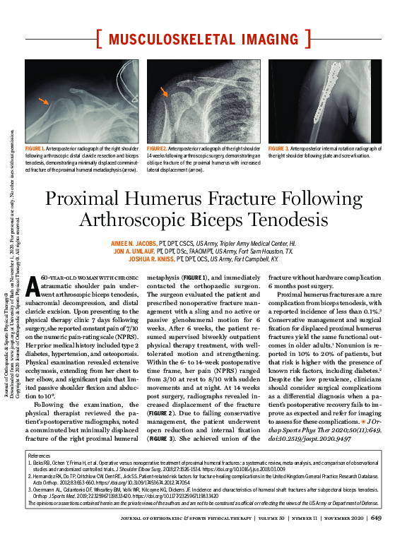 (PDF) Proximal Humerus Fracture Following Arthroscopic Biceps Tenodesis