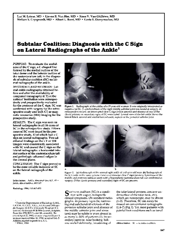 (PDF) Subtalar coalition: diagnosis with the C sign on lateral ...