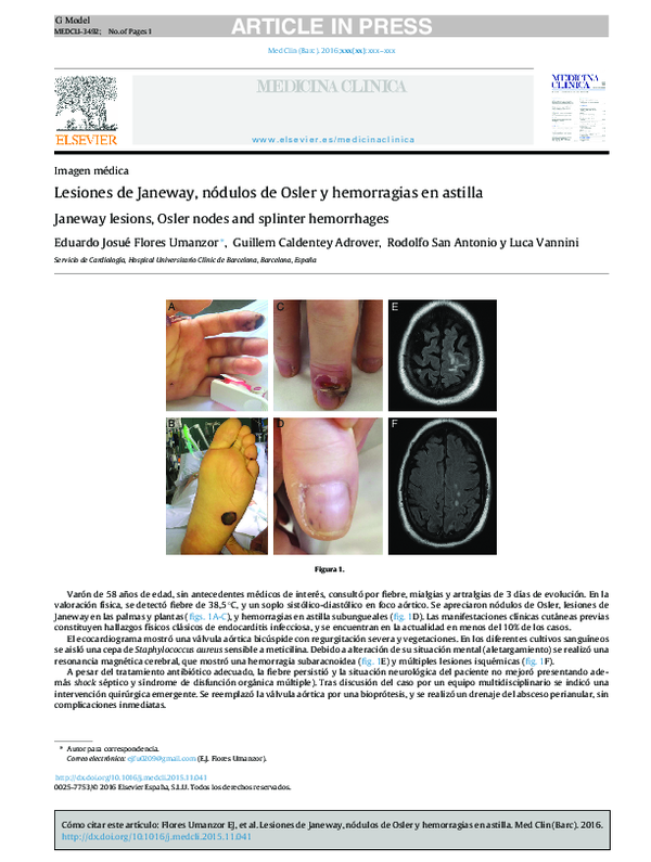 (PDF) Janeway lesions, Osler nodes and splinter hemorrhages