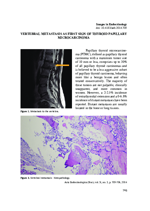 (PDF) Vertebral Metastasis as First Sign of Thyroid Papillary Microcarcinoma