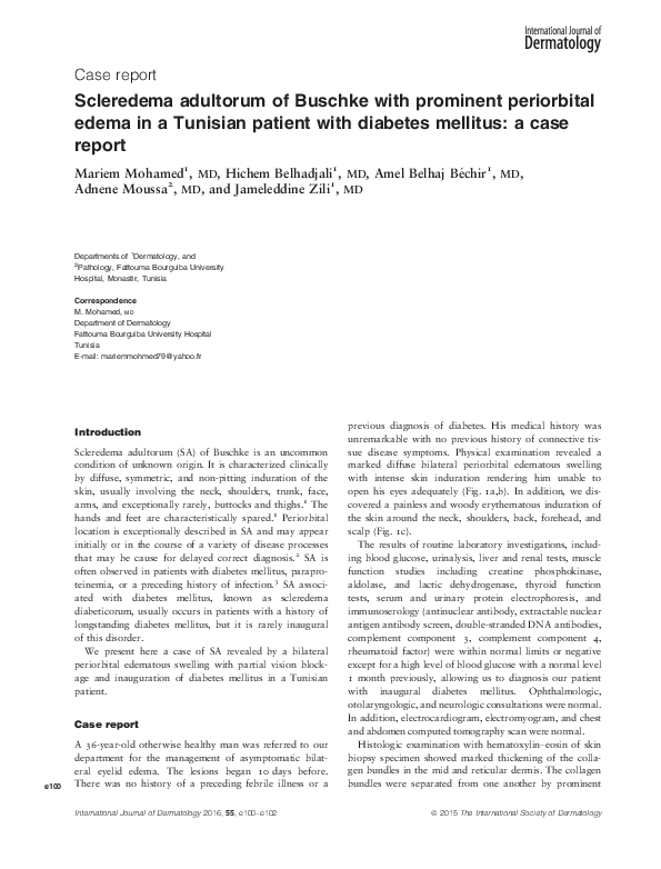 (PDF) Scleredema adultorum of Buschke with prominent periorbital edema ...