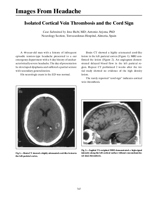 (PDF) Isolated Cortical Vein Thrombosis and the Cord Sign