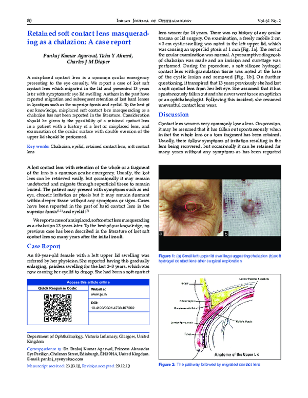 (PDF) Retained soft contact lens masquerading as a chalazion: A case report