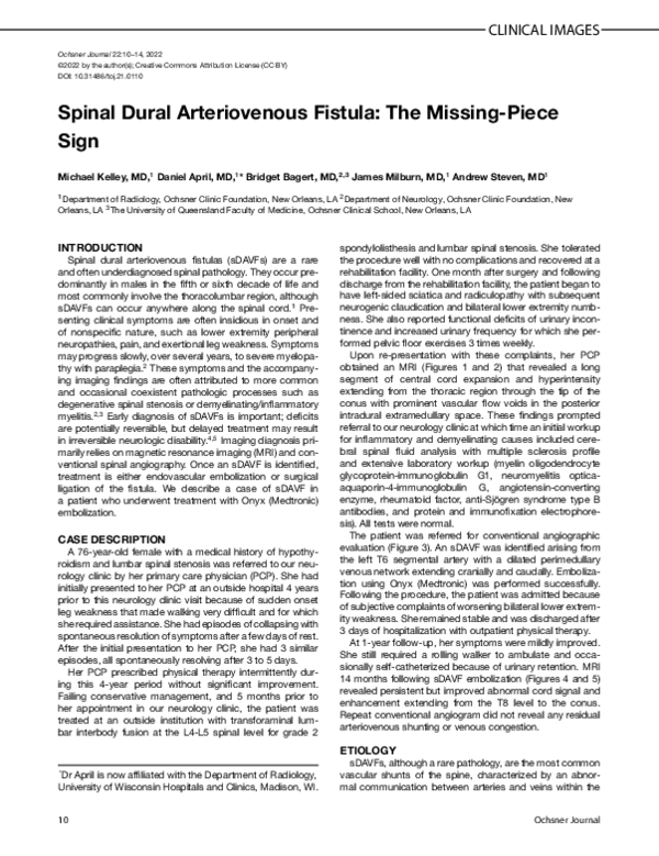(PDF) Spinal Dural Arteriovenous Fistula: The Missing-Piece Sign