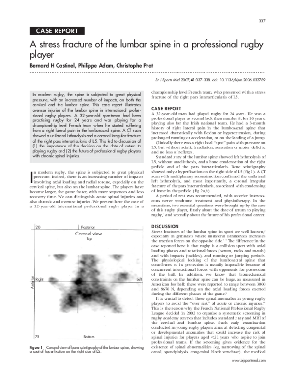 (PDF) A stress fracture of the lumbar spine in a professional rugby player
