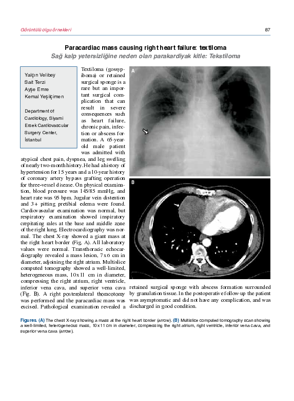 (PDF) Paracardiac mass causing right heart failure: textiloma