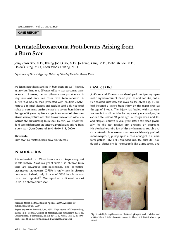 (PDF) Dermatofibrosarcoma Protuberans Arising From a Burn Scar of the ...