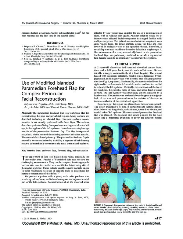 (PDF) Use of Modified Islanded Paramedian Forehead Flap for Complex ...