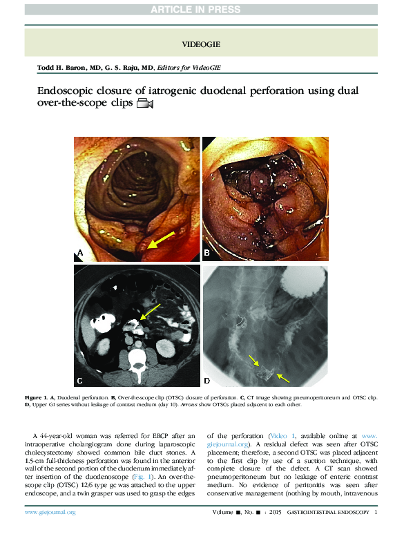 (PDF) Endoscopic closure of iatrogenic duodenal perforation during EUS ...