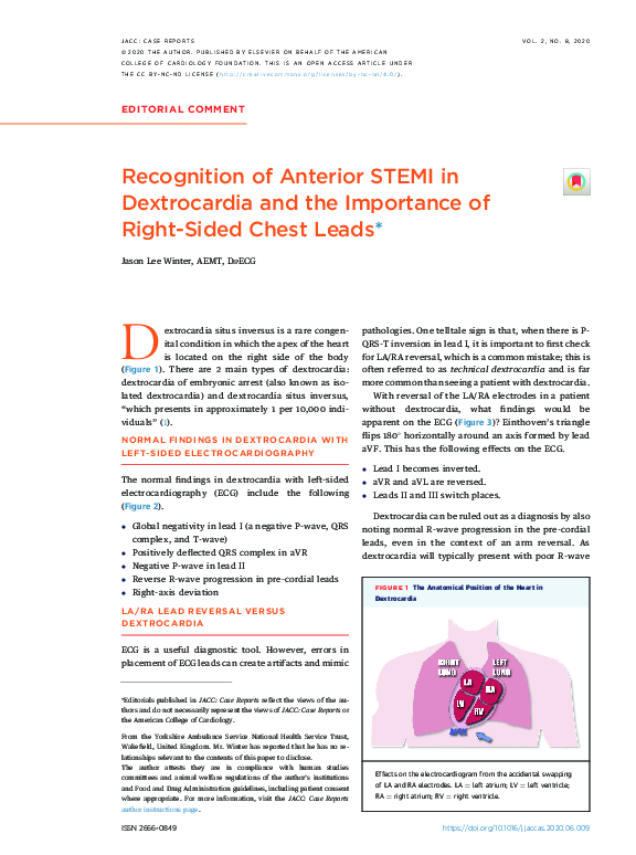 Recognition of Anterior STEMI in Dextrocardia and the Importance of ...