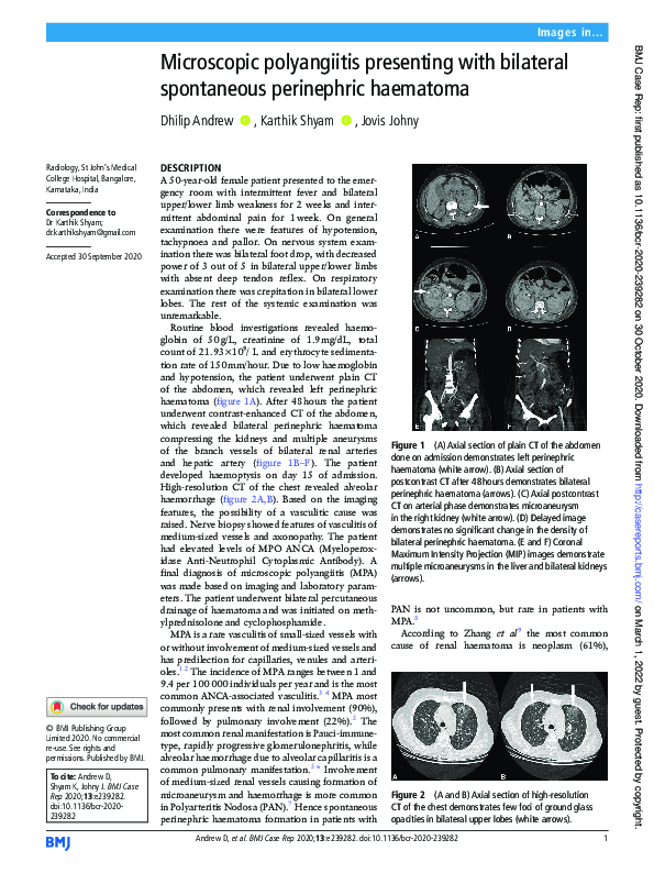 (PDF) Microscopic polyangiitis presenting with bilateral spontaneous perinephric haematoma