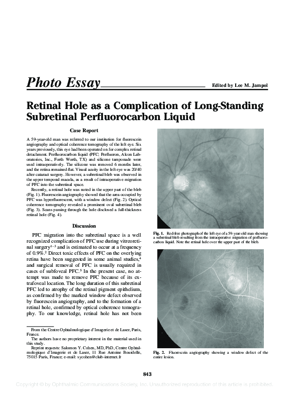 (PDF) Retinal Hole as a Complication of Long-Standing Subretinal Perfluorocarbon Liquid