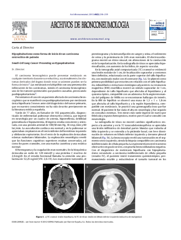 (PDF) Hipopituitarismo como forma de inicio de un carcinoma microcítico ...