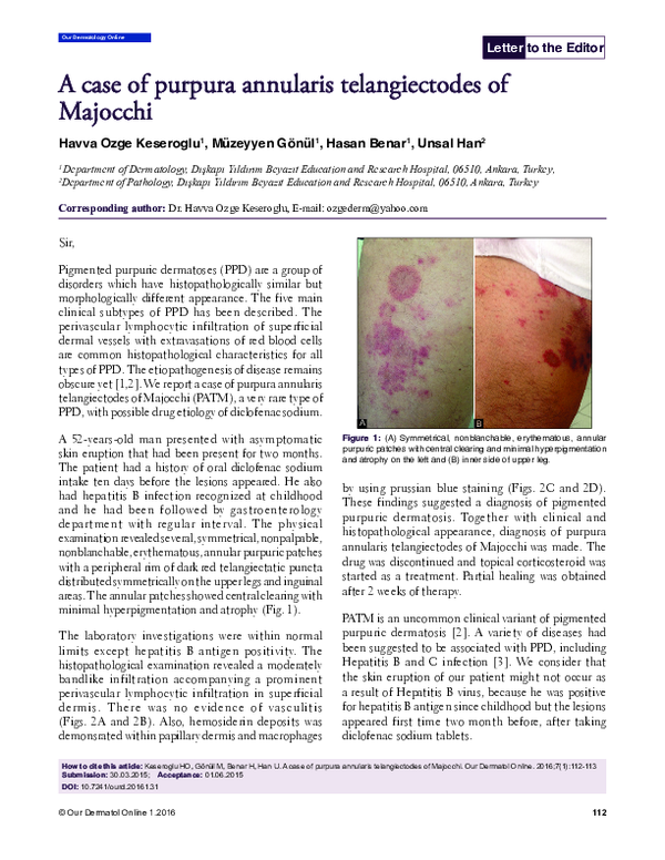 (PDF) A case of purpura annularis telangiectodes of Majocchi