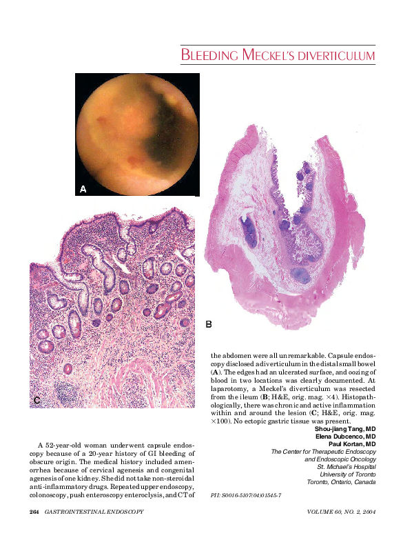 (PDF) Bleeding meckel's diverticulum