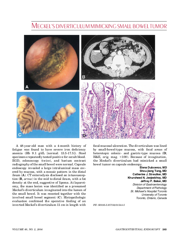 (PDF) Meckel's diverticulum mimicking small bowel tumor