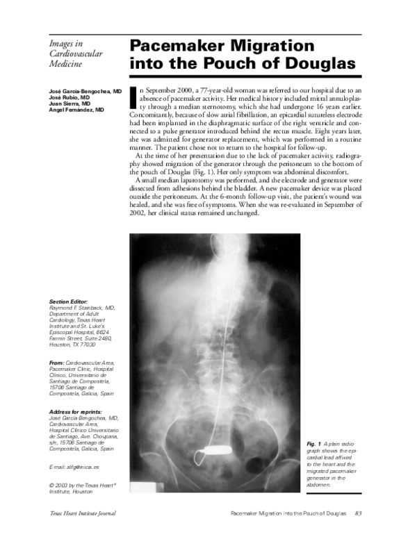 (PDF) Pacemaker migration into the pouch of Douglas