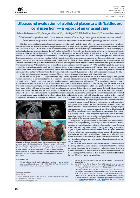 (PDF) Ultrasound evaluation of a bilobed placenta with ‘battledore cord ...