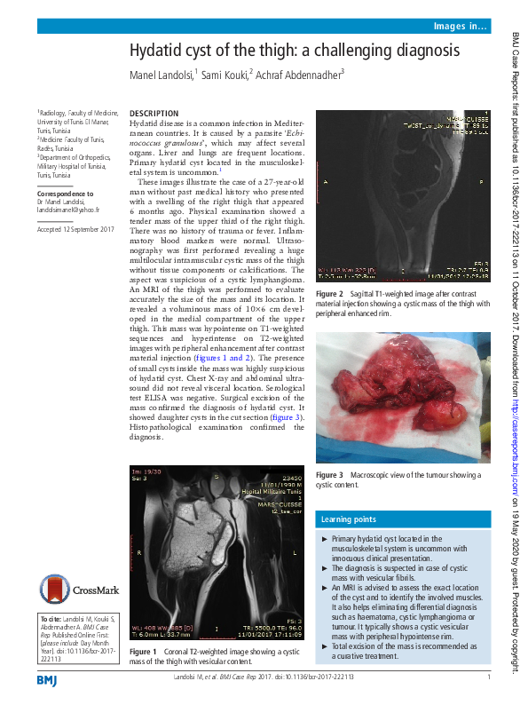 (PDF) Hydatid cyst of the thigh: a challenging diagnosis