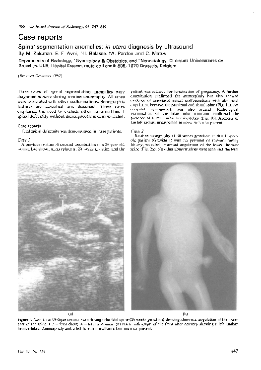 (PDF) Spinal segmentation anomalies:in uterodiagnosis by ultrasound ...