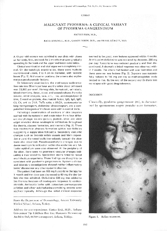 (PDF) Malignant Pyoderma: A Clinical Variant of Pyoderma Gangrenosum