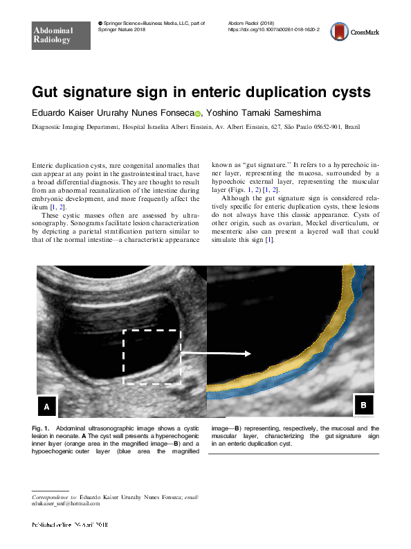 (PDF) Gut signature sign in enteric duplication cysts