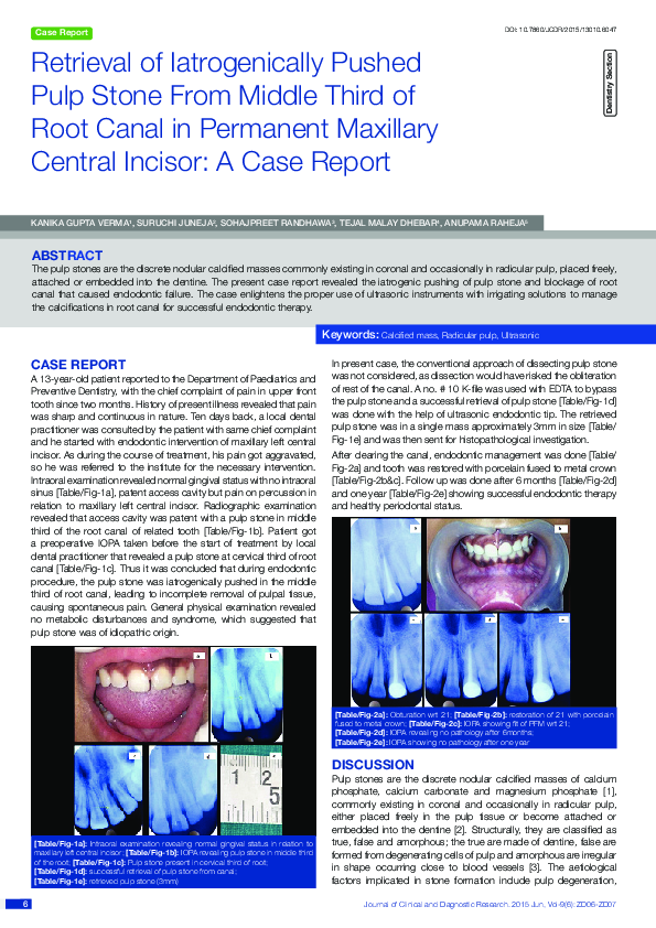 (PDF) Retrieval of Iatrogenically Pushed Pulp Stone From Middle Third ...