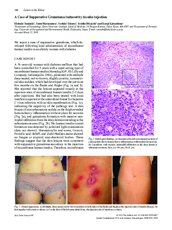 (PDF) A Case of Suppurative Granuloma Induced by Insulin Injection