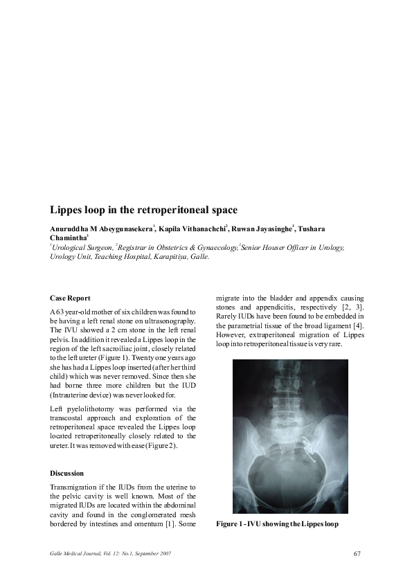 (PDF) Lippes loop in the retroperitoneal space | ruwan jayasinghe ...