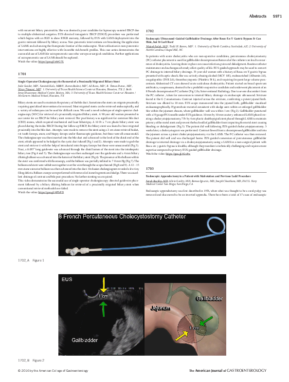 (PDF) Single Operator Cholangioscopy for Removal of a Proximally ...