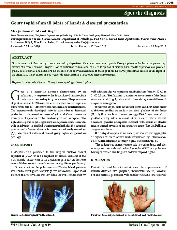 (PDF) Gouty Tophi of Small Joints of Hand: A Classical Presentation
