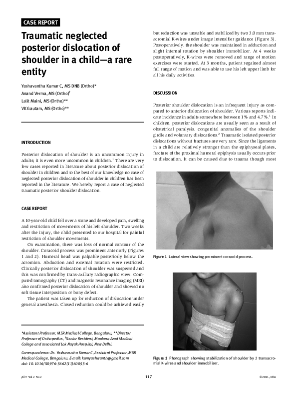 (PDF) Traumatic neglected posterior dislocation of shoulder in a child–a rare entity | Lalit ...