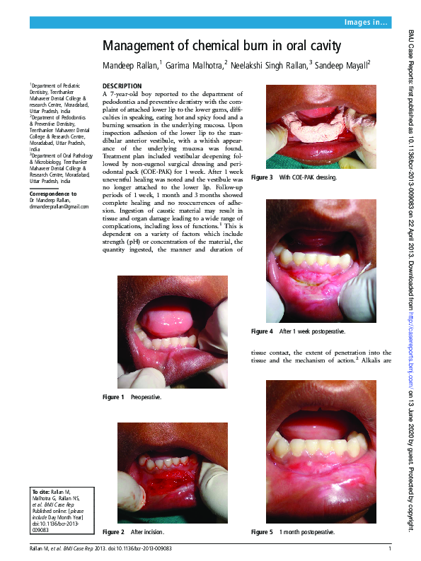 (PDF) Management of chemical burn in oral cavity
