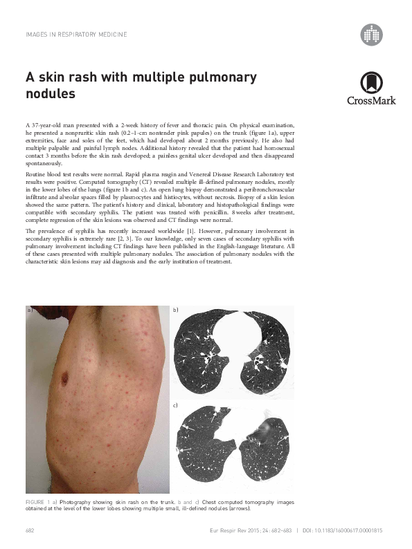 (PDF) A skin rash with multiple pulmonary nodules | Gláucia Zanetti ...