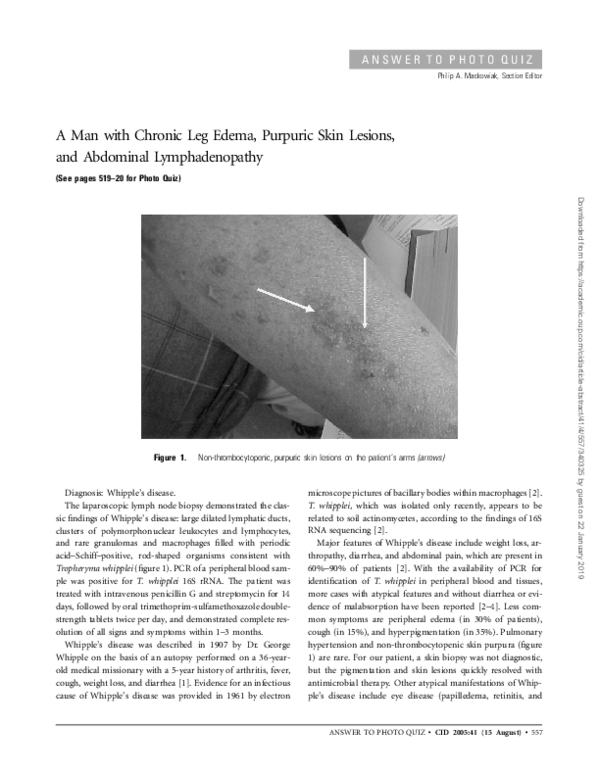 (PDF) A Man with Chronic Leg Edema, Purpuric Skin Lesions, and ...