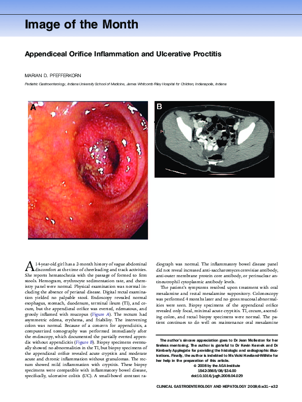 (PDF) Appendiceal Orifice Inflammation and Ulcerative Proctitis