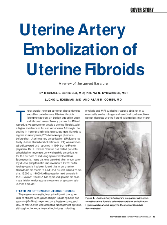 (PDF) Uterine Artery Embolization of Uterine Fibroids